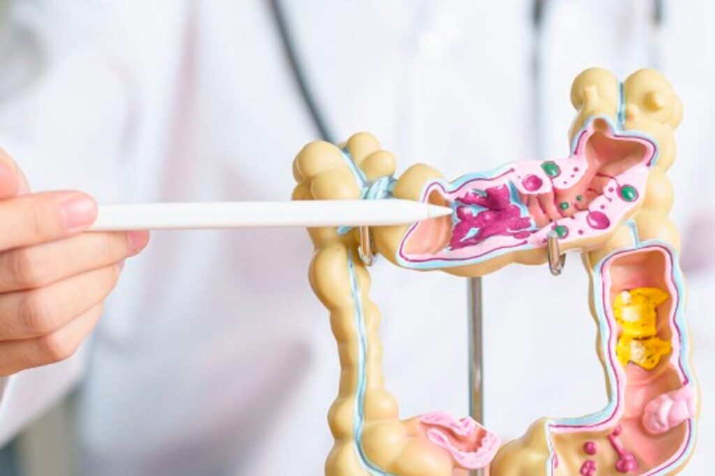 Mortalidade por câncer colorretal cresce 20% na América Latina